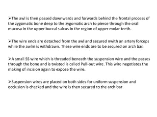 Transosseus wiring circumferential wiring dentoalveolar fracture | PPTX