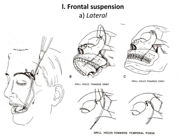 Transosseus wiring circumferential wiring dentoalveolar fracture | PPTX ...