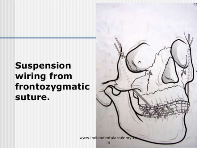Transosseus wiring circumferential wiring dentoalveolar fracture | PPT