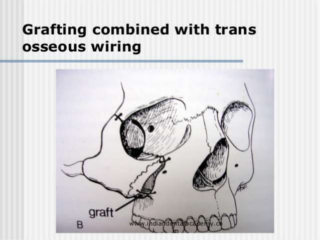 Transosseus wiring circumferential wiring dentoalveolar fracture | PPTX ...