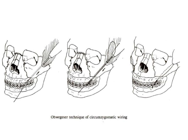 Transosseus wiring circumferential wiring dentoalveolar fracture | PPTX ...
