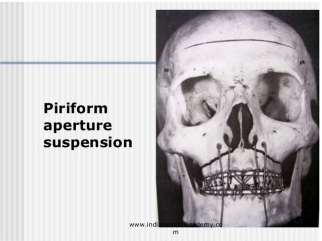 Transosseus wiring circumferential wiring dentoalveolar fracture | PPTX ...
