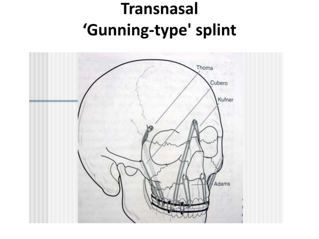 Transosseus wiring circumferential wiring dentoalveolar fracture | PPTX ...