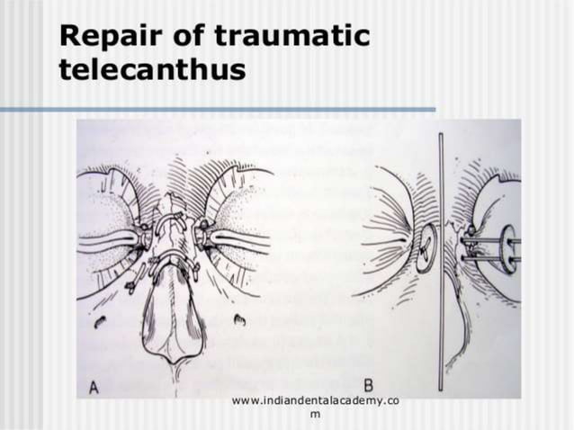 Transosseus wiring circumferential wiring dentoalveolar fracture | PPTX ...