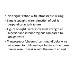 Transosseus wiring circumferential wiring dentoalveolar fracture | PPTX ...