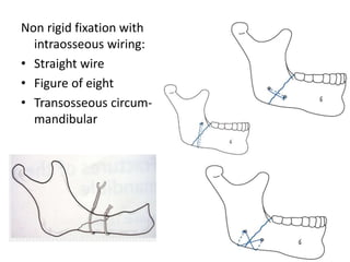 Transosseus wiring circumferential wiring dentoalveolar fracture | PPTX ...