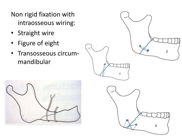 Transosseus wiring circumferential wiring dentoalveolar fracture | PPTX ...