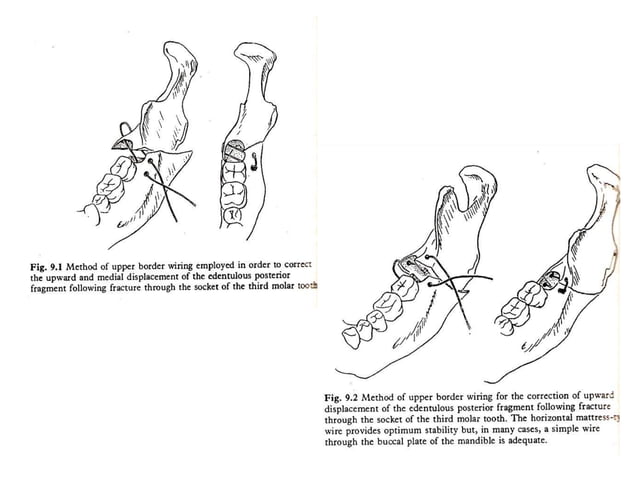 Transosseus wiring circumferential wiring dentoalveolar fracture