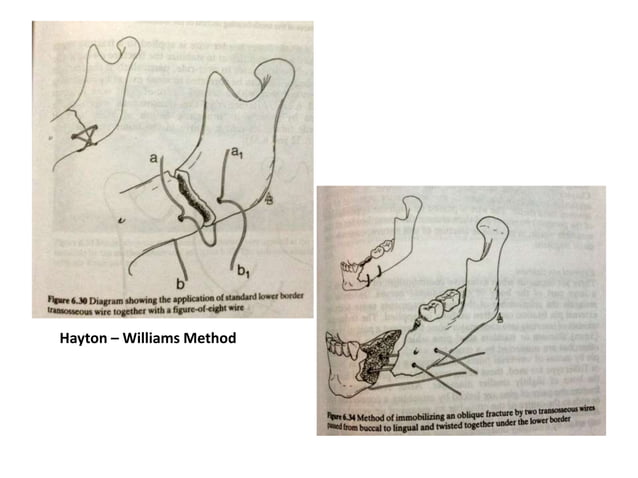 Transosseus wiring circumferential wiring dentoalveolar fracture