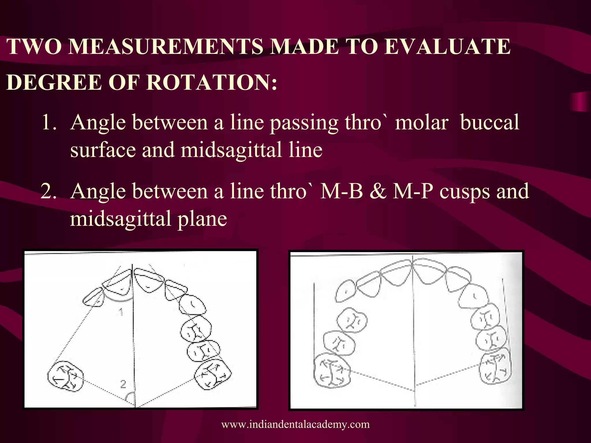 Transpalatal arch for molar rotation | PPT