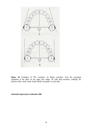 Transpalatal, nance, lingual arch, quadhelix appliances for ...