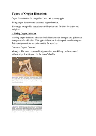 Transplantation approach - organ donation.docx