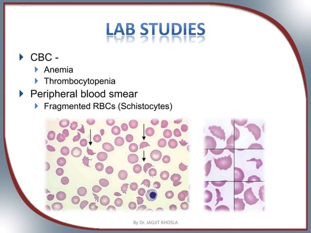 Transplantation associated Thrombotic microangiopathy (TA-TMA) | PPTX ...