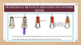 Transplantation of decidous teeth pulp.pptx