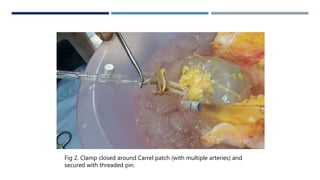 Transplantation Surgery | PPTX