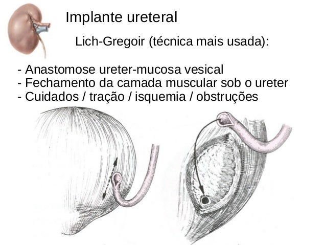 Transplante renal - Liga de Nefrologia UFC - Sobral