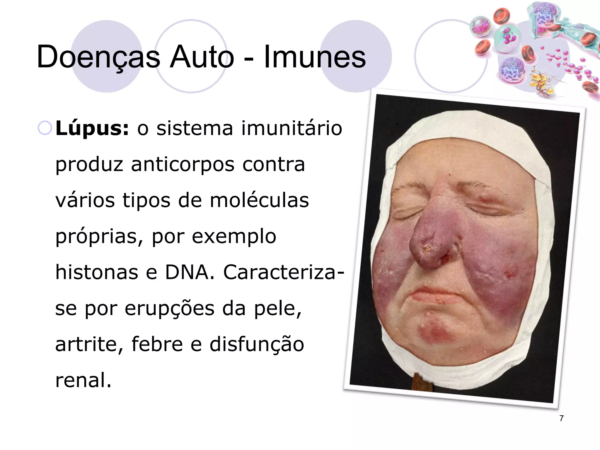 Doenças Auto-Imunes, Transplantes e Alergias | PPT