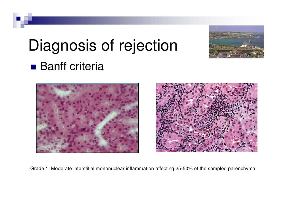 Transplant example presentation