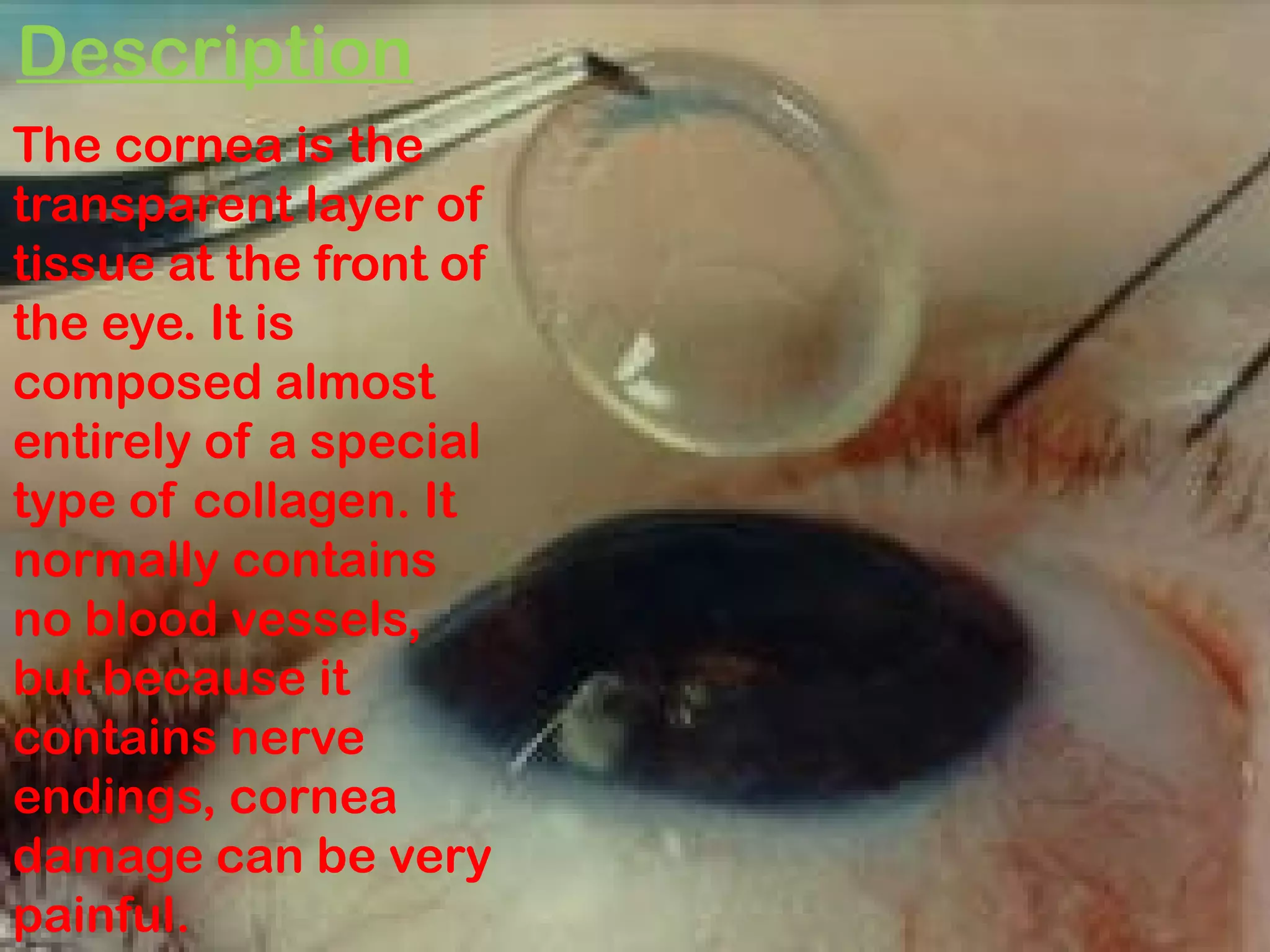 Transplant of cornea | PPT