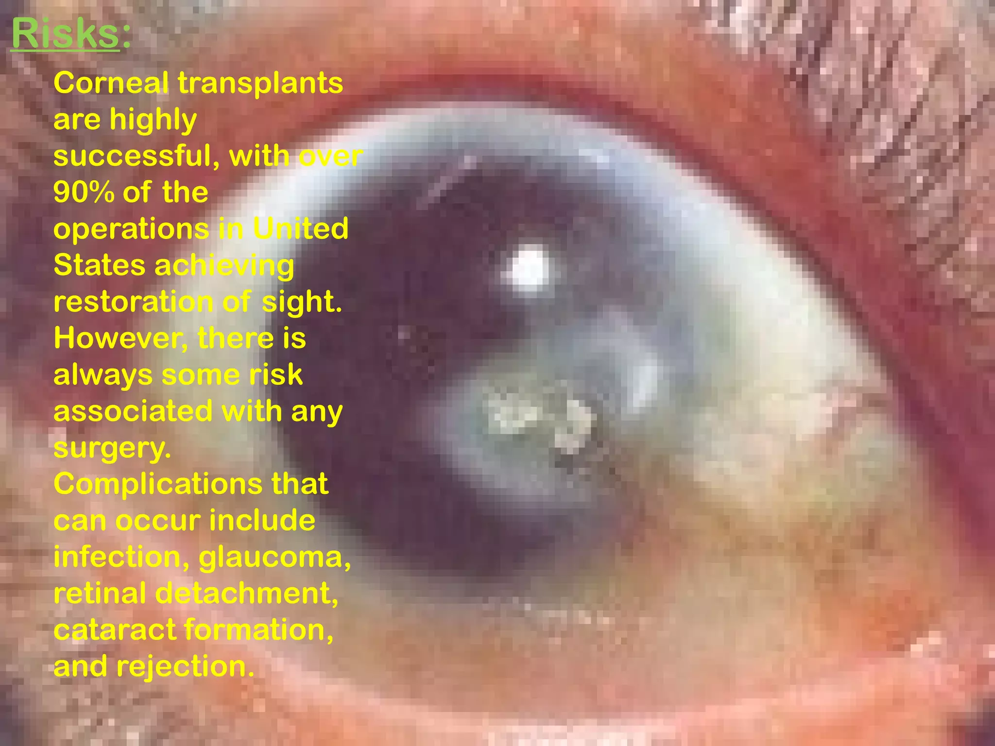 Transplant of cornea | PPT