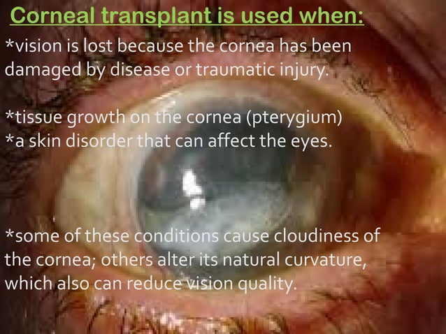 Transplant of cornea | PPT