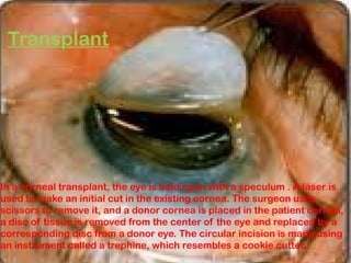 Transplant of cornea | PPT
