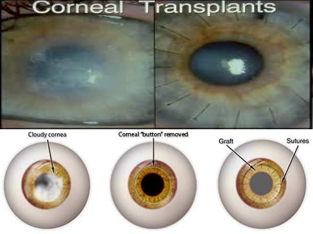 Transplant of cornea | PPT