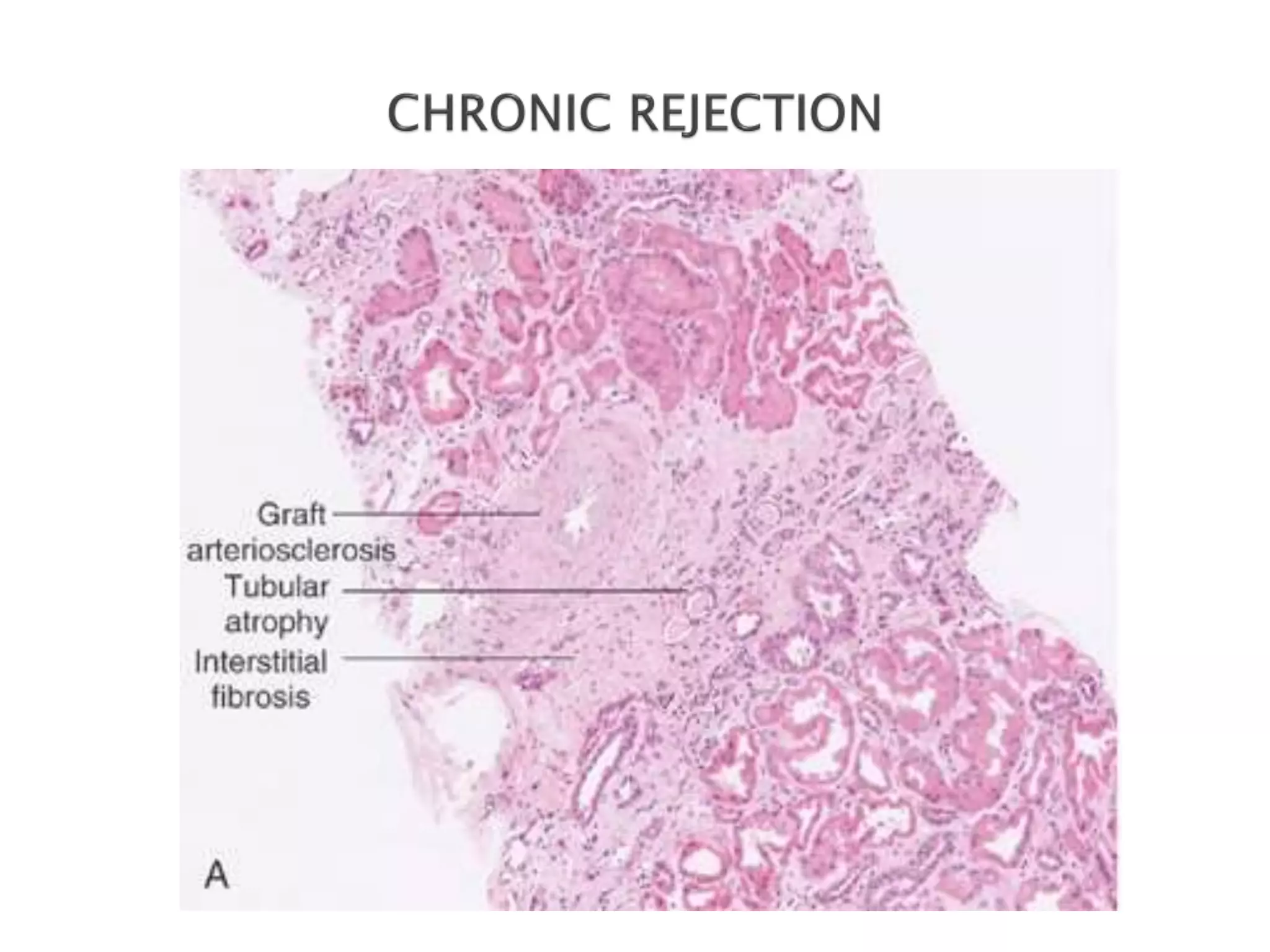 Transplant rejection | PPTX