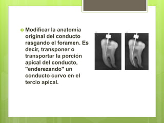 Transportación apical .pptx
