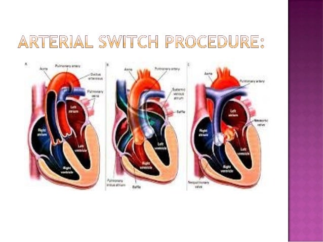 Transposition of great arteries