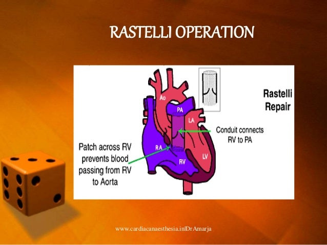 Transposition of great_arteries