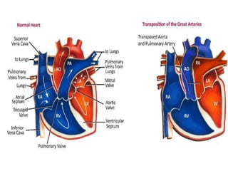 Transposition of great arteries | PPTX