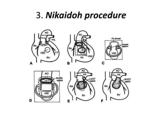Transposition of great arteries | PPT