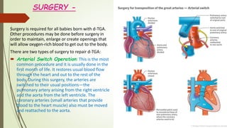 Transposition of Great Arteries(TGA) by Суд Ааруши.pptx