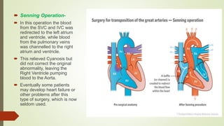 Transposition of Great Arteries(TGA) by Суд Ааруши.pptx