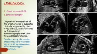 Transposition of Great Arteries(TGA) by Суд Ааруши.pptx