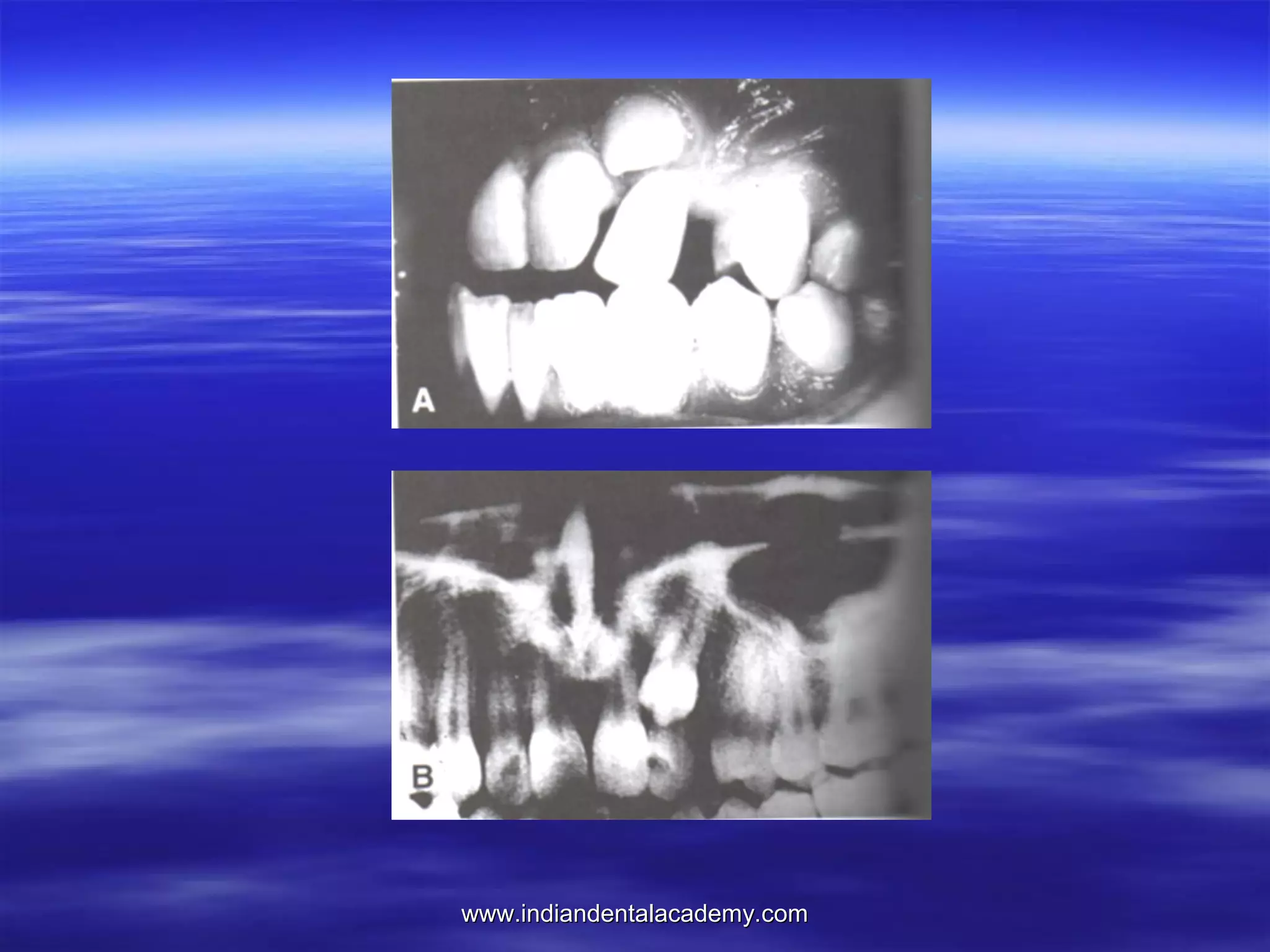 Transposition of teeth & its management | PPT