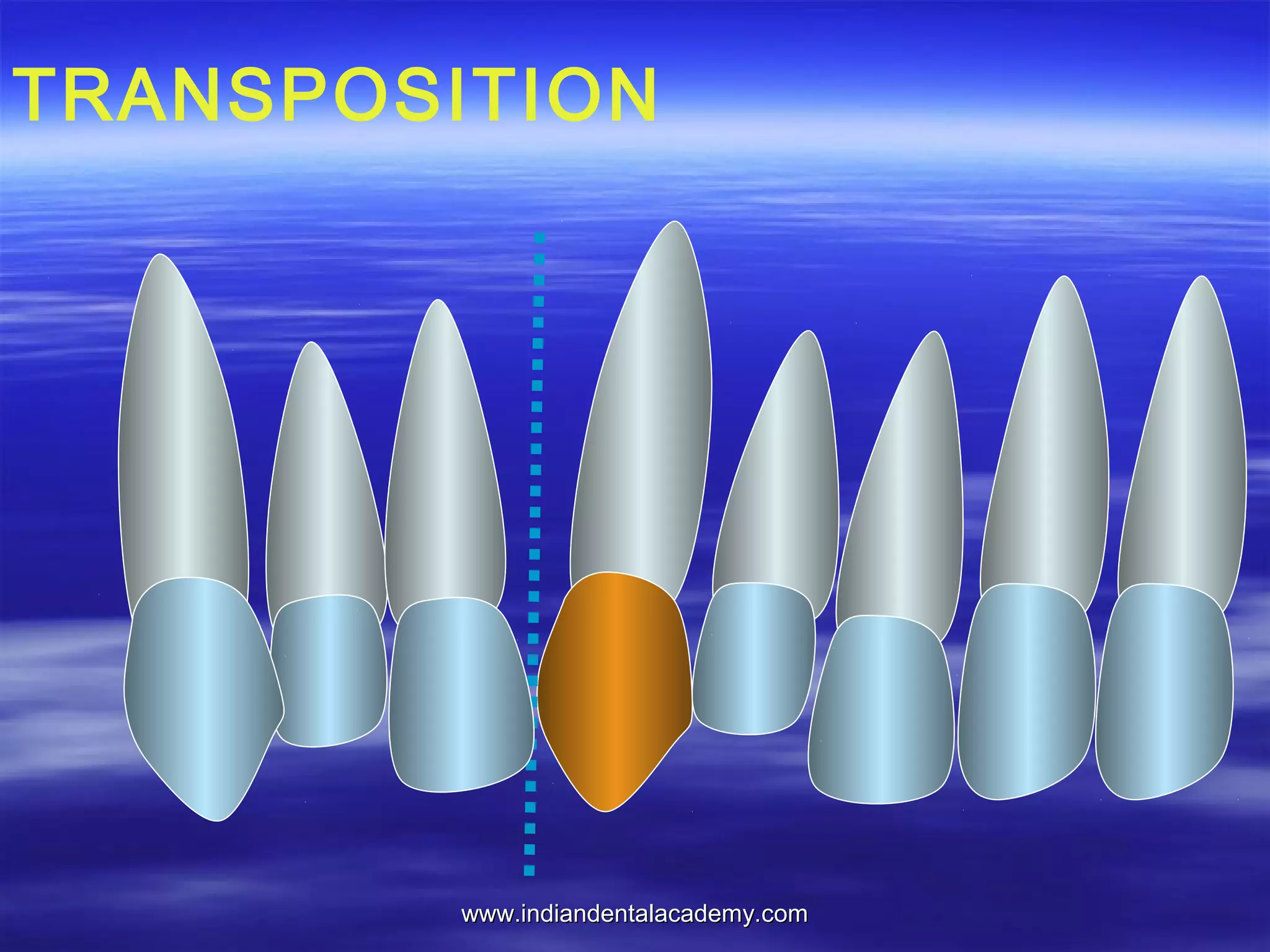 Transposition of teeth & its management | PPT | Dental Health ...