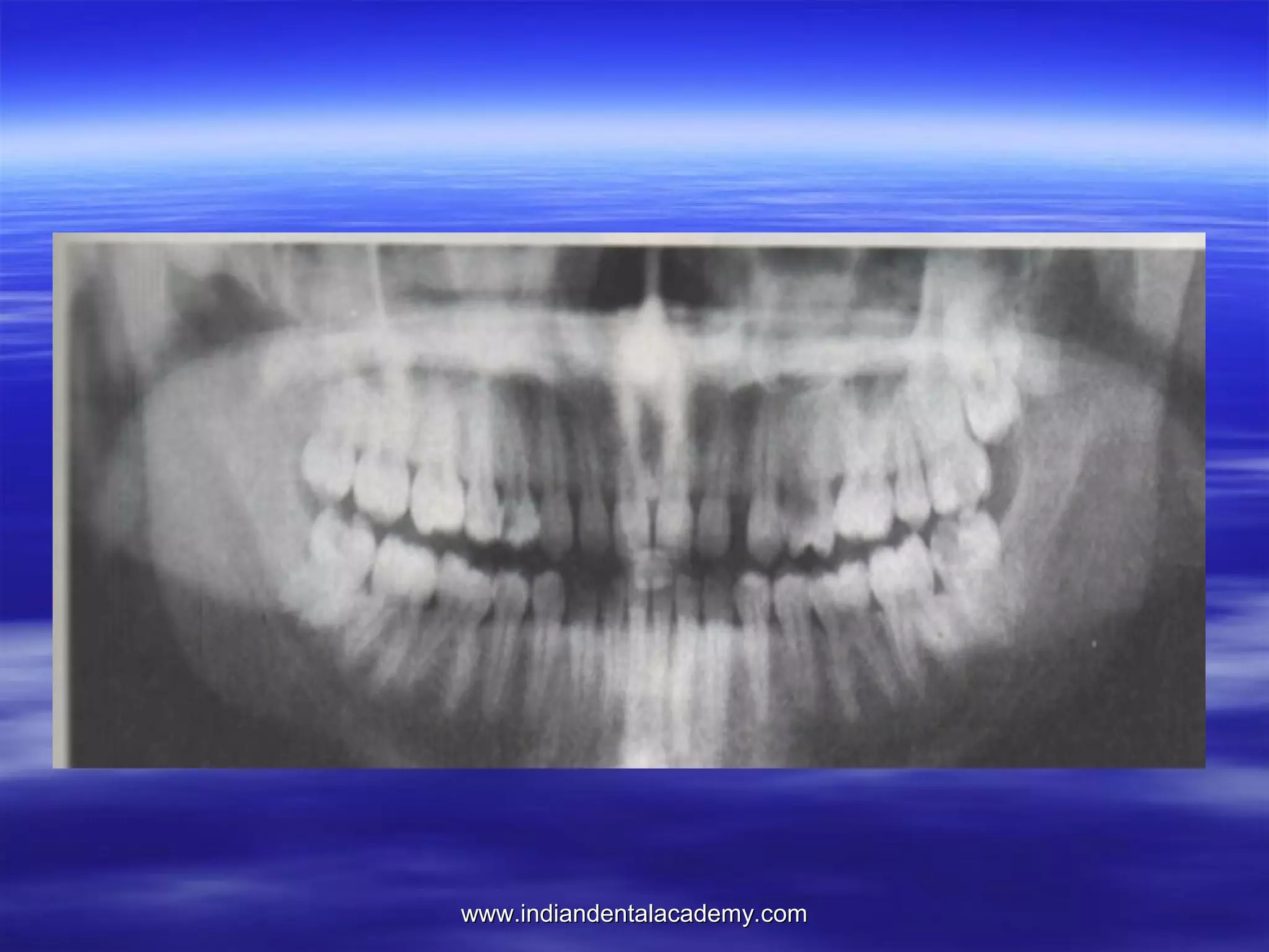 Transposition of teeth & its management | PPT