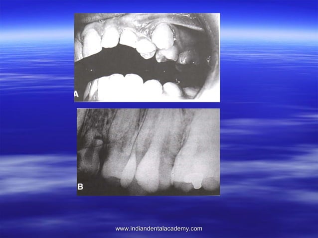 Transposition of teeth & its management | PPT | Dental Health ...