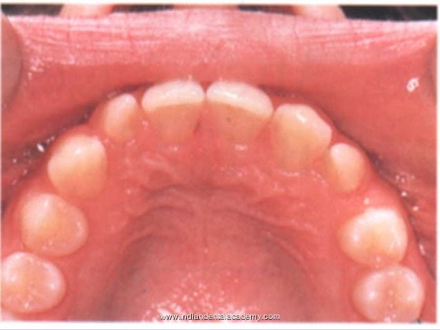 Transposition of teeth & its management