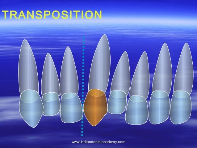 Transposition of teeth & its management