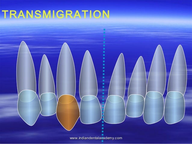Transposition of teeth & its management
