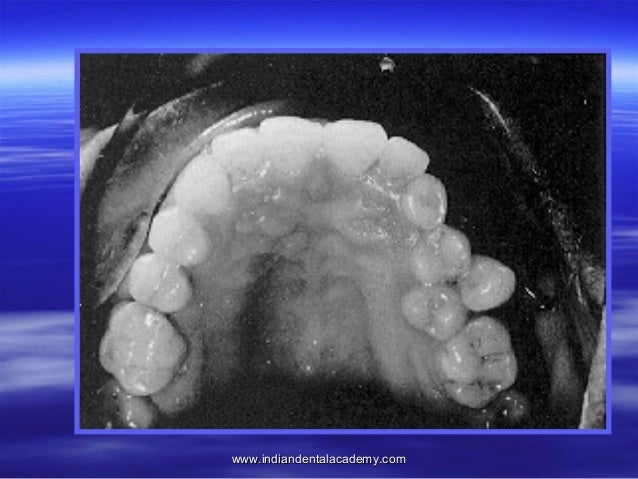 Transposition of teeth & its management