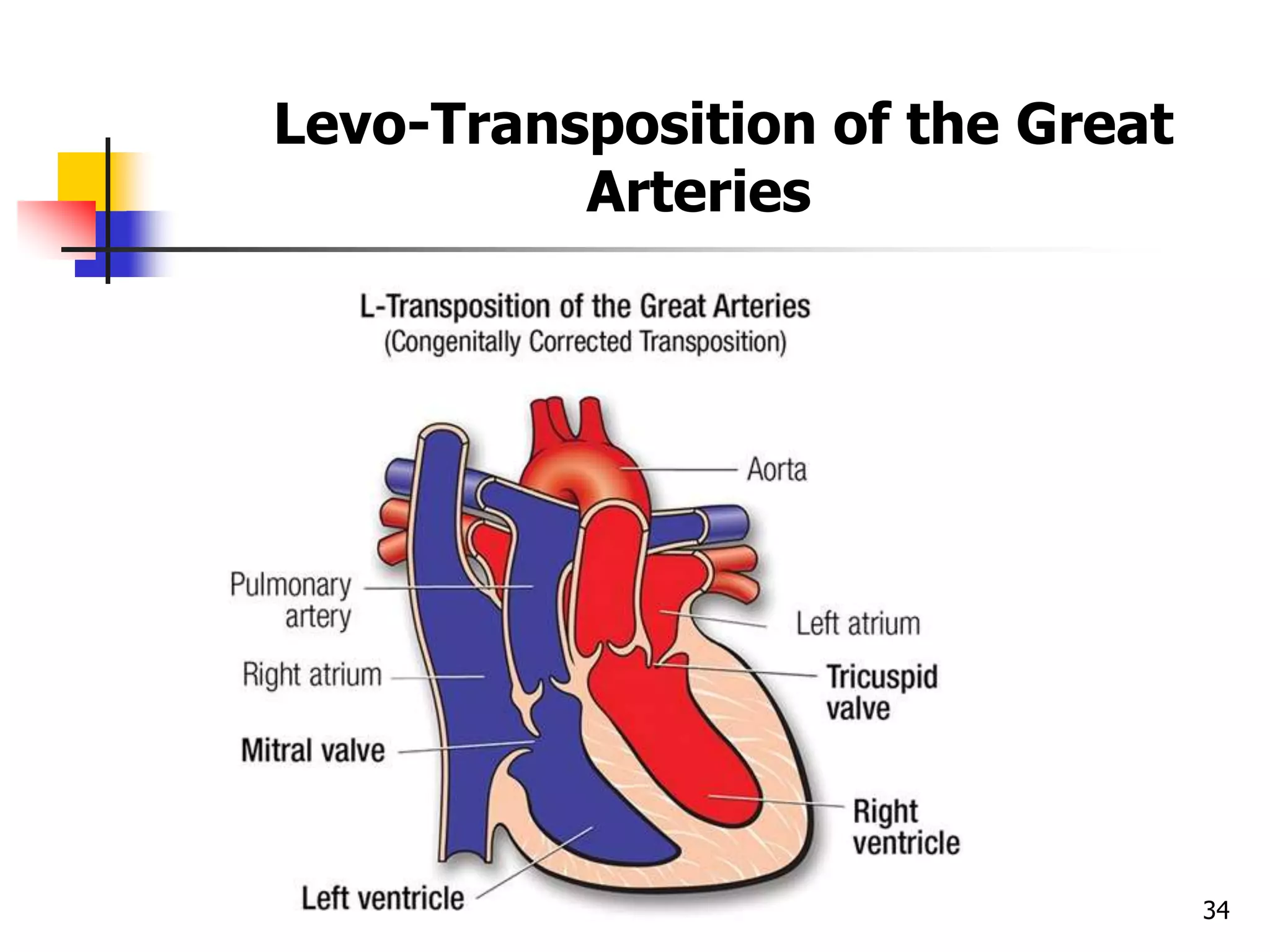 Transposition of the great arteries | PPT