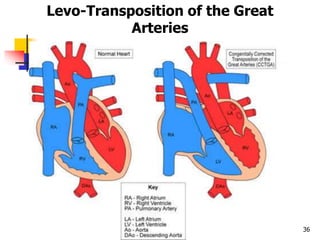 Transposition of the great arteries | PPT