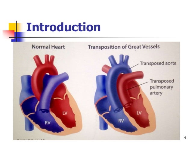 Transposition of the great arteries | PPT | Heart and Cardiovascular ...