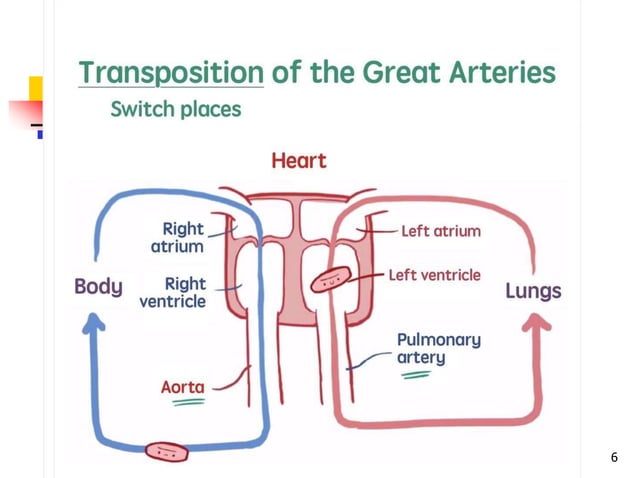 Transposition of the great arteries | PPT | Heart and Cardiovascular ...