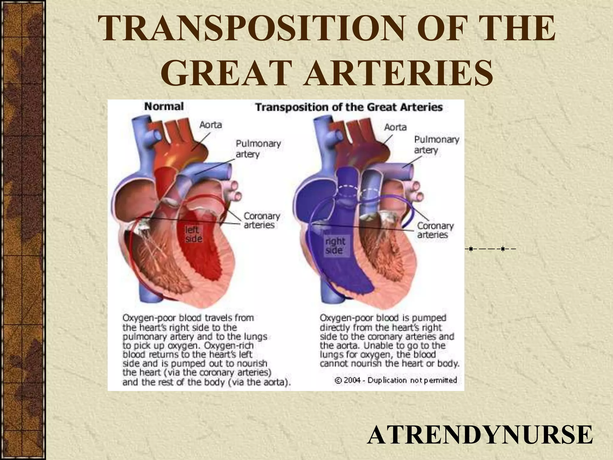 Transposition of the great arteries | PPT