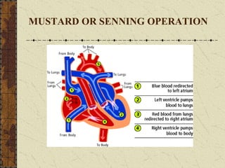 Transposition of the great arteries | PPT